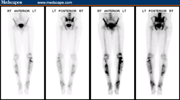 Compartment Syndrome and Stress Fractures After Exercise - Page 2