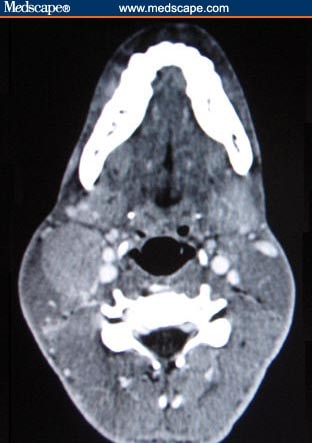 Nasopharyngeal Carcinoma: The Role of the Epstein-Barr Virus - Page 3