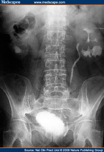 Primary Lymphoma of the Bladder Managed With Multimodal Therapy - Page 2