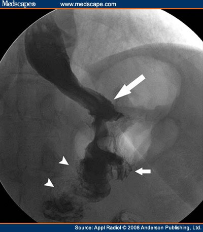 Normal Anatomy And Complications Of Bariatric Surgery An