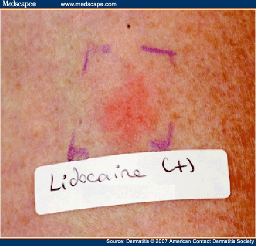 Contact Allergy to Lidocaine: A Report of Sixteen Cases - Page 3