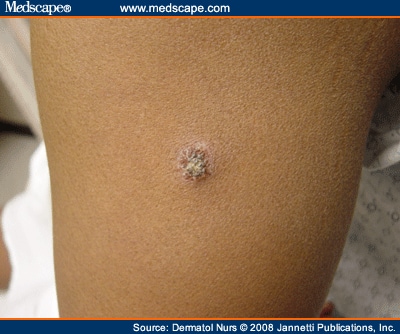 Skin Infections in Athletes - Page 2