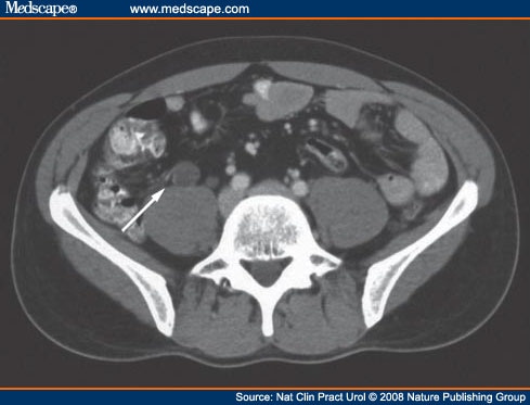 A Case of Spermatic Cord Teratoma in Low-Stage Testicular Cancer