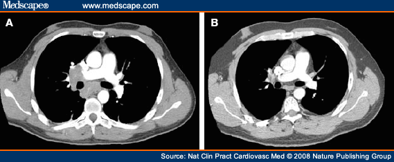 Tubercular Myocarditis Presenting With Ventricular Tachycardia