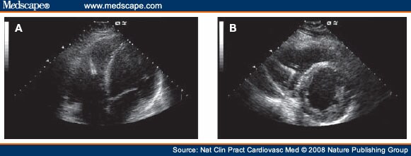 A Case of Cardiac Sarcoidosis Concealed by Right Ventricular Dyslplasia A Case of Cardiac Sarcoidosis Concealed by Right Ventricular Dyslplasia