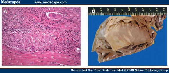 A Case of Cardiac Sarcoidosis Concealed by Right Ventricular Dyslplasia A Case of Cardiac Sarcoidosis Concealed by Right Ventricular Dyslplasia