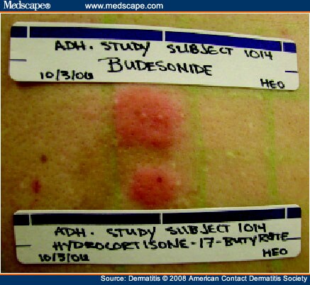 Allergic Contact Dermatitis from Medical Adhesive Bandages - Page 2