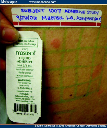 Allergic Contact Dermatitis from Medical Adhesive Bandages - Page 3