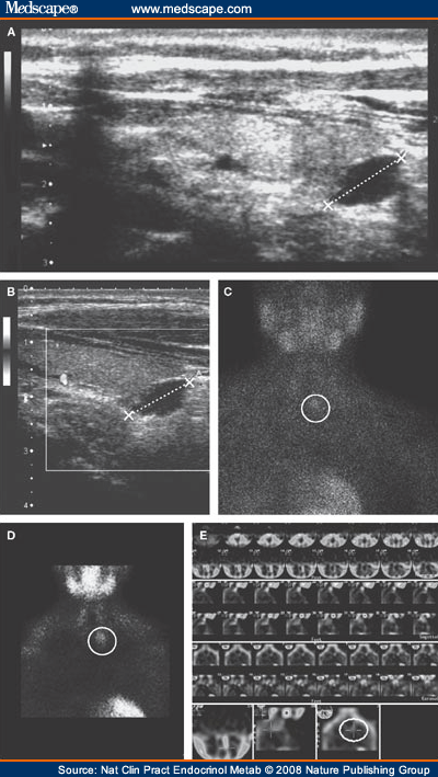 A Patient With the MEN1-Associated Hyperparathyroidism