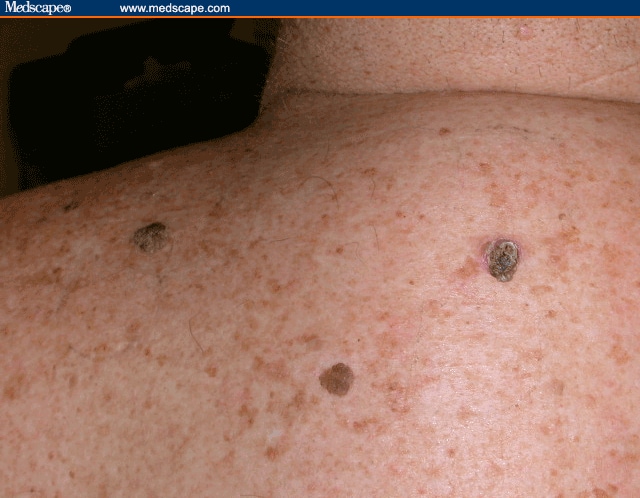 Normal Aging of the Skin