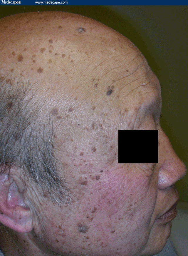 Normal Aging of the Skin