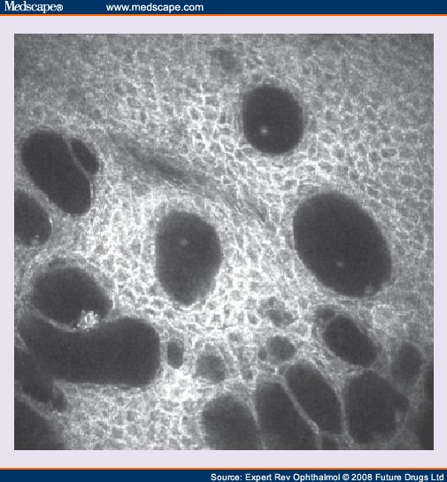 Confocal Microscopy: Diagnosing Corneal and Conjunctival Diseases - Page 6