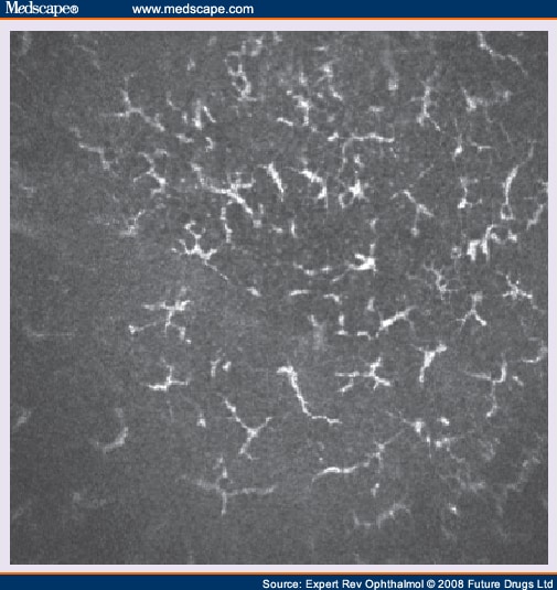 Confocal Microscopy: Diagnosing Corneal and Conjunctival Diseases - Page 2