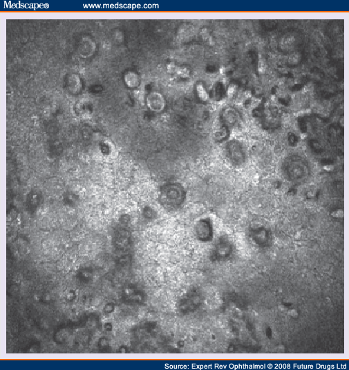 Confocal Microscopy: Diagnosing Corneal and Conjunctival Diseases - Page 2