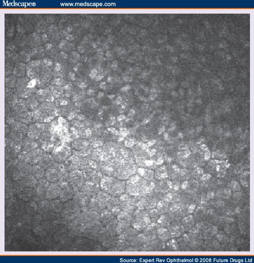 Confocal Microscopy: Diagnosing Corneal and Conjunctival Diseases - Page 2