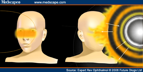 Mechanism and Emergency Management of Blast Eye/Orbital Injuries - Page 5