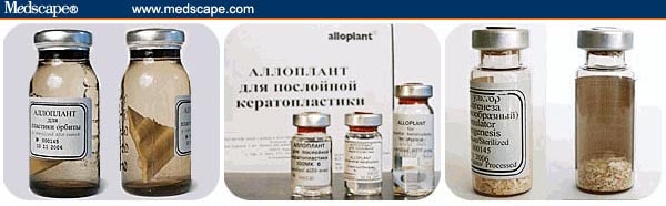 Alloplant Implant: Novel Biomaterial for Managing Recalcitrant Glaucoma