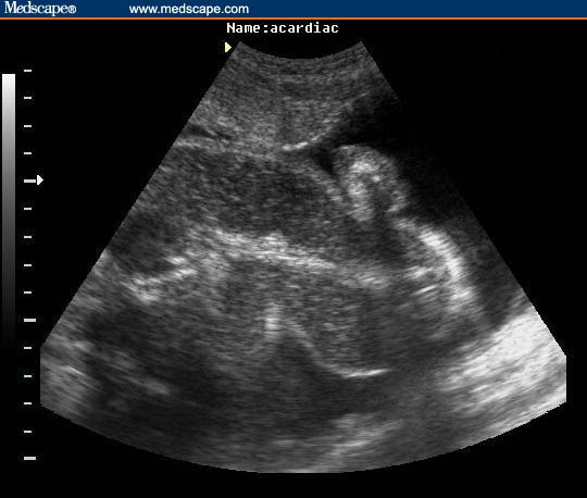 Acardiac-Acephalus Twins: A Report of 2 Cases and Review of Literature ...