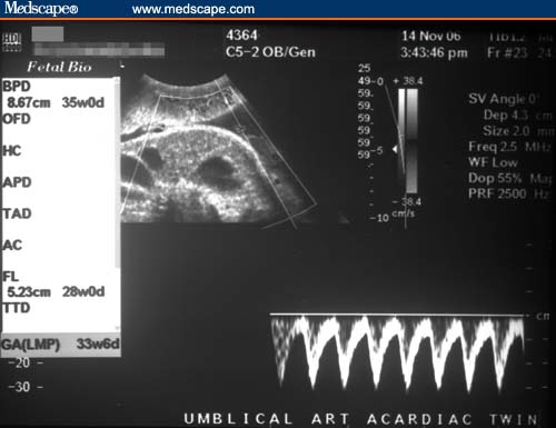 Acardiac-Acephalus Twins: A Report of 2 Cases and Review of Literature ...