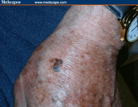 What Do Pathologic Skin Lesions in Elderly Patients Look Like?