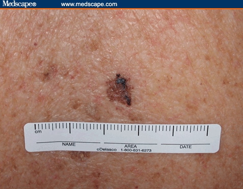 What Do Pathologic Skin Lesions in Elderly Patients Look Like?