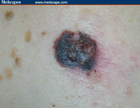 What Do Pathologic Skin Lesions in Elderly Patients Look Like?