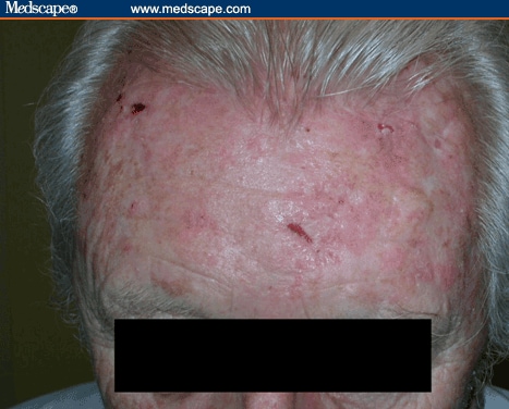 What Do Pathologic Skin Lesions in Elderly Patients Look Like?