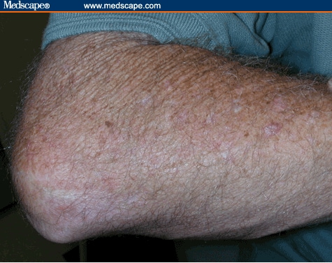 What Do Pathologic Skin Lesions in Elderly Patients Look Like?
