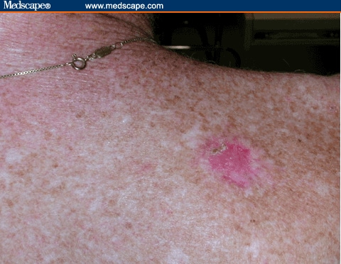 What Do Pathologic Skin Lesions in Elderly Patients Look Like?