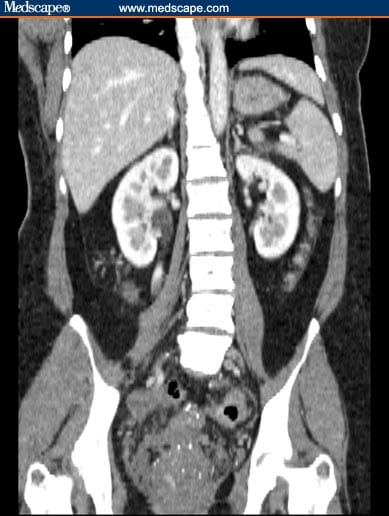 Massive Hemorrhage in Pregnancy Caused by a Diffuse Cavernous ...