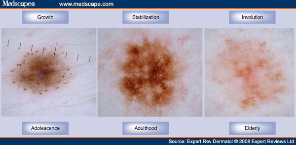 New Classification of Melanocytic Nevi Based on Dermoscopy