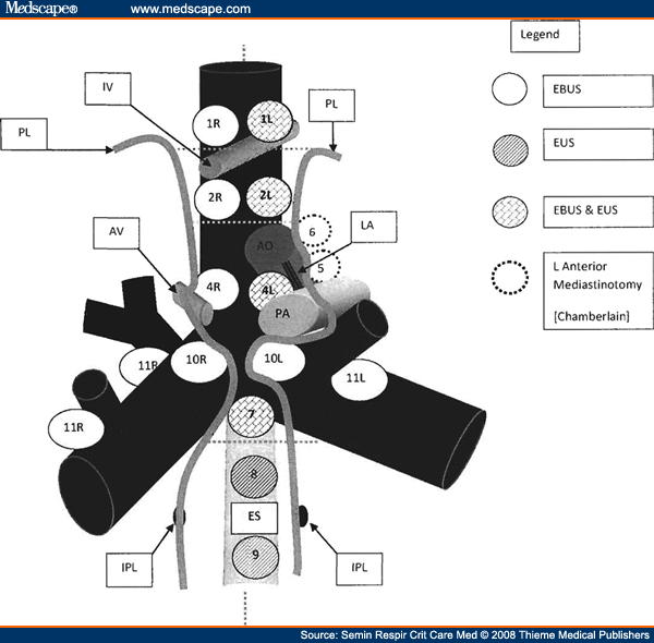 Bronchoscopy for the Diagnosis and Staging of Lung Cancer
