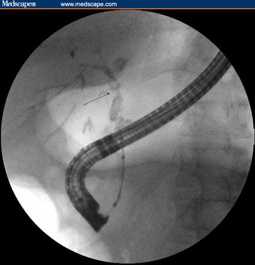 Endoscopic and Surgical Management of Primary Sclerosing Cholangitis ...