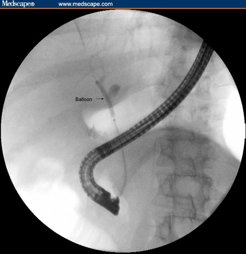 Endoscopic and Surgical Management of Primary Sclerosing Cholangitis ...