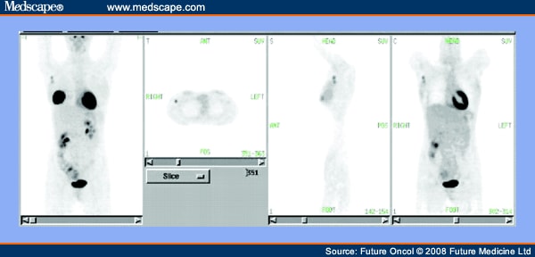New Diagnostic Techniques for Breast Cancer Detection - Page 5