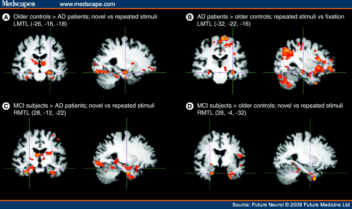 fMRI: Use In Early Alzheimer's Disease And In Clinical Trials - Page 3