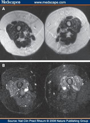 Therapy Insight: Rheumatic Disease in HIV Infection - Page 2
