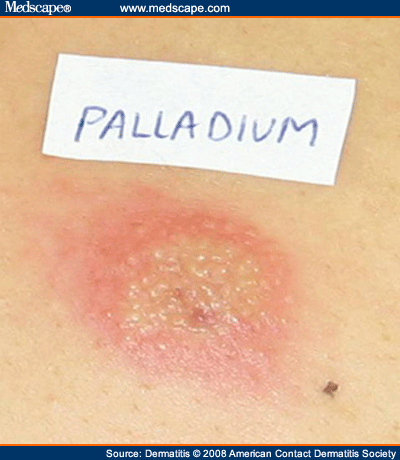 Granuloma Possibly Induced by Palladium After Ear Piercing - Page 2