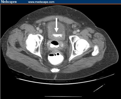 Palliation of a Malignant Rectal Stricture and Rectovesical Fistula