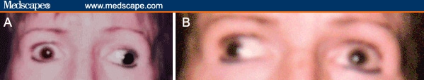 A 55-Year-Old Woman With Double Vision