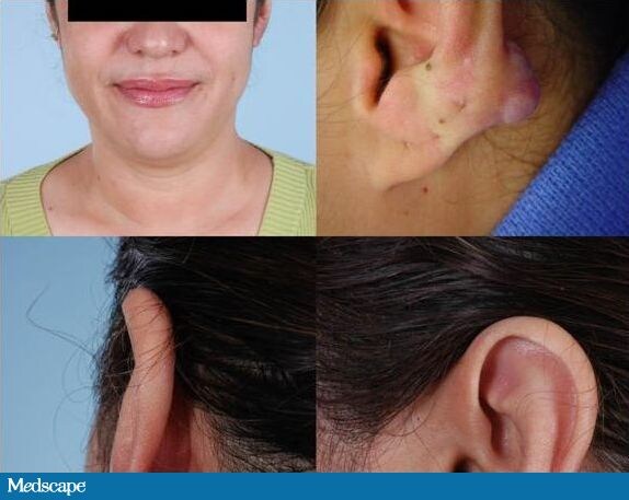 A Primary Care Perspective on Keloids - Page 6