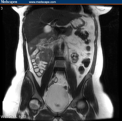 Case of Obscure GI Bleeding Secondary to Small Bowel GIST Detected by MRE