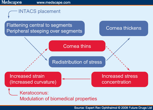 Intracorneal Ring Segments for Keratoconus