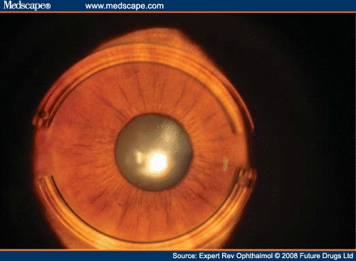 Intracorneal Ring Segments for Keratoconus - Page 2