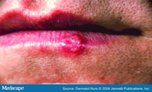 Nurse Practitioner's Guide, Herpes Simplex Virus-1 in Children - Page 4