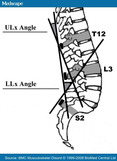 Regional Differences in Lumbar Spinal Posture and the Influence of LBP ...
