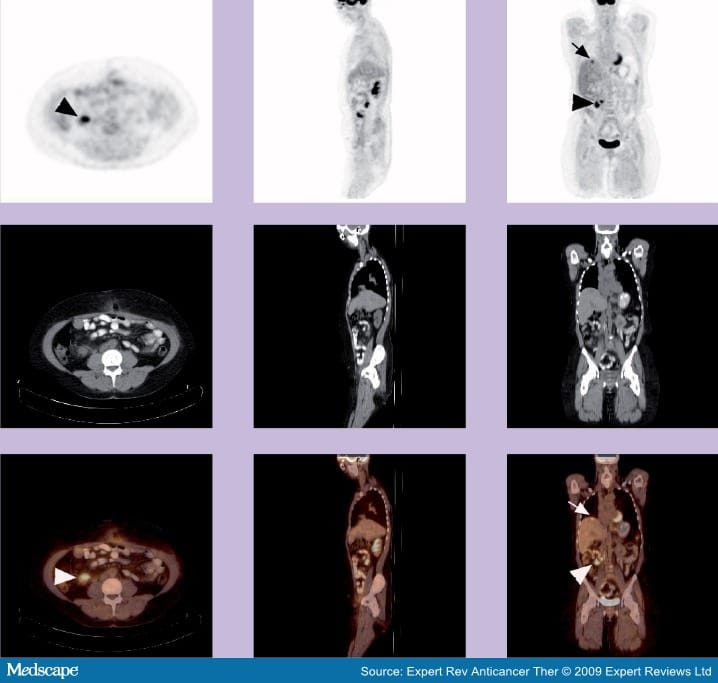 PET and PET-CT Imaging of Gynecological Malignancies: Present and Future