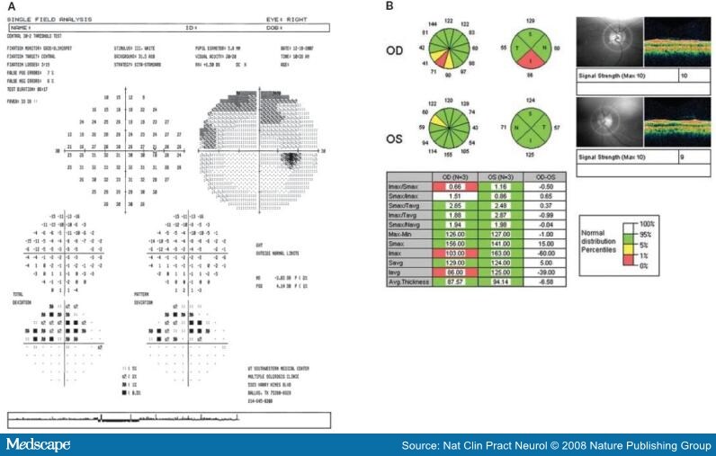 Optical Coherence Tomography: A Window Into MS - Page 5