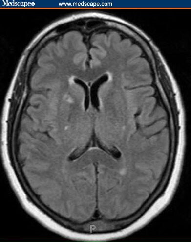 Optic Neuritis: Diagnosis, Treatment, and Prognosis