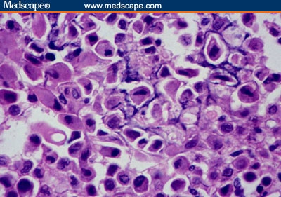 Case Series in Anatomic Pathology From the University of Iowa: A 13 ...